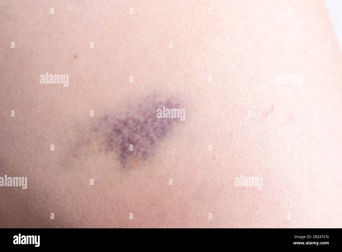 Closeup Blue Purple Hematoma, Bruise On Thigh, Hip After Trauma, Fall ...
