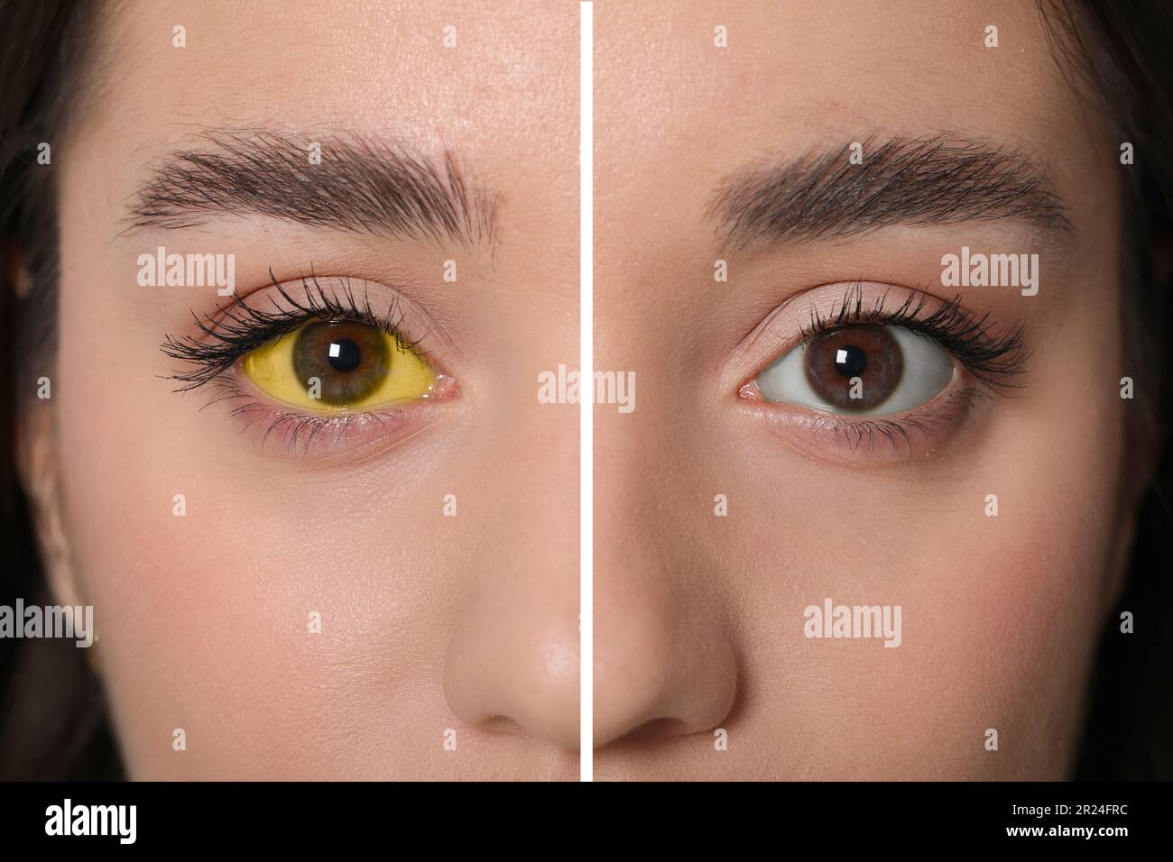 Collage with photos of woman before and after hepatitis treatment ...