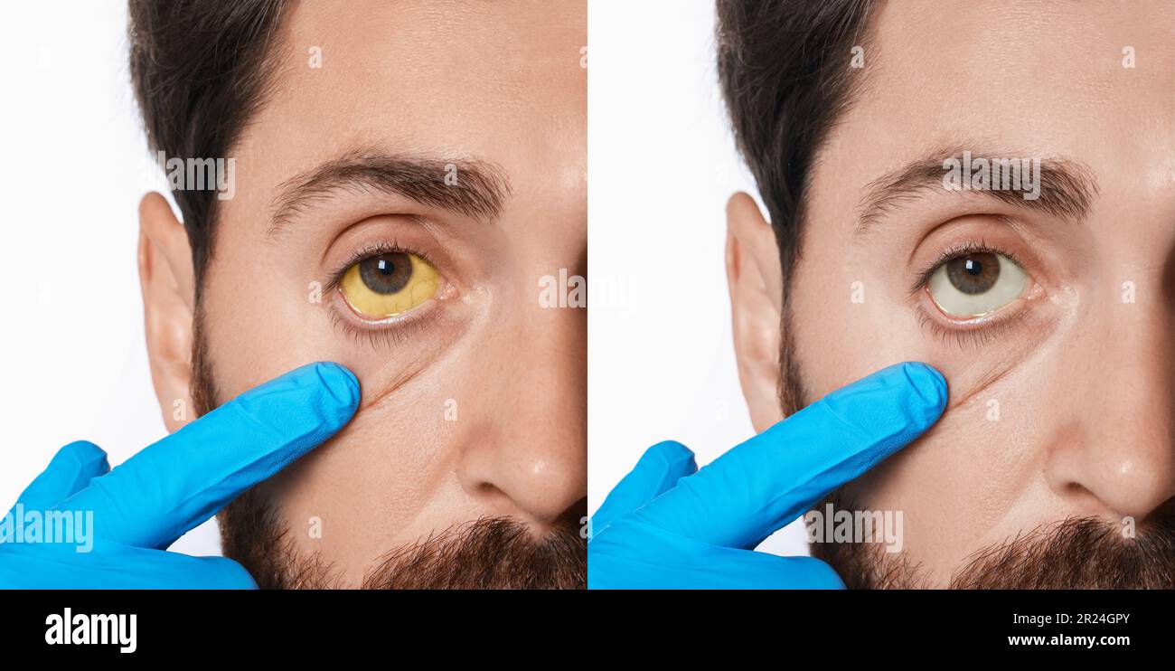 Collage with photos of man before and after hepatitis treatment. Doctor ...