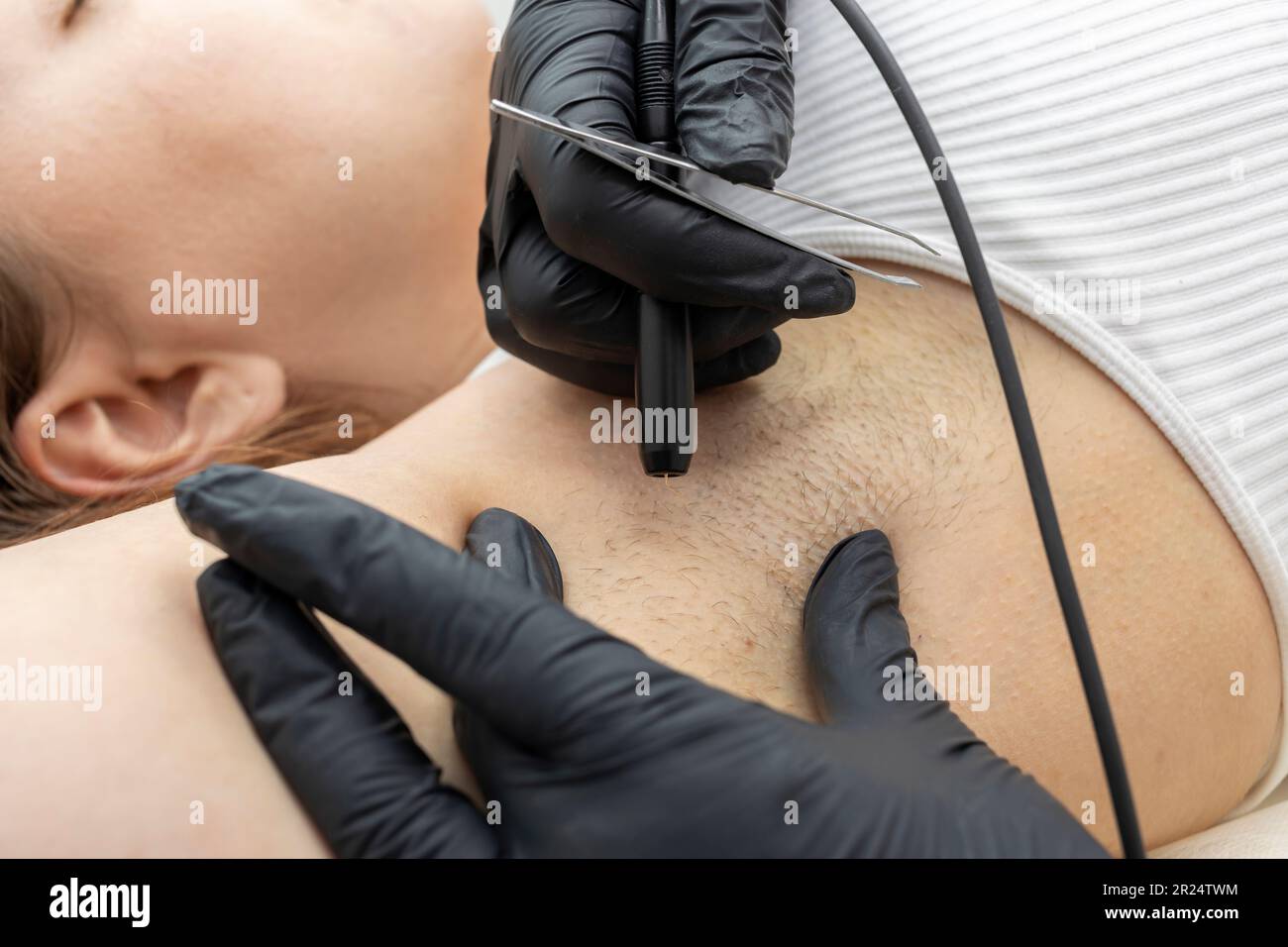 Closeup Dermatologist Removing Hair On Patient's Underarms With ...