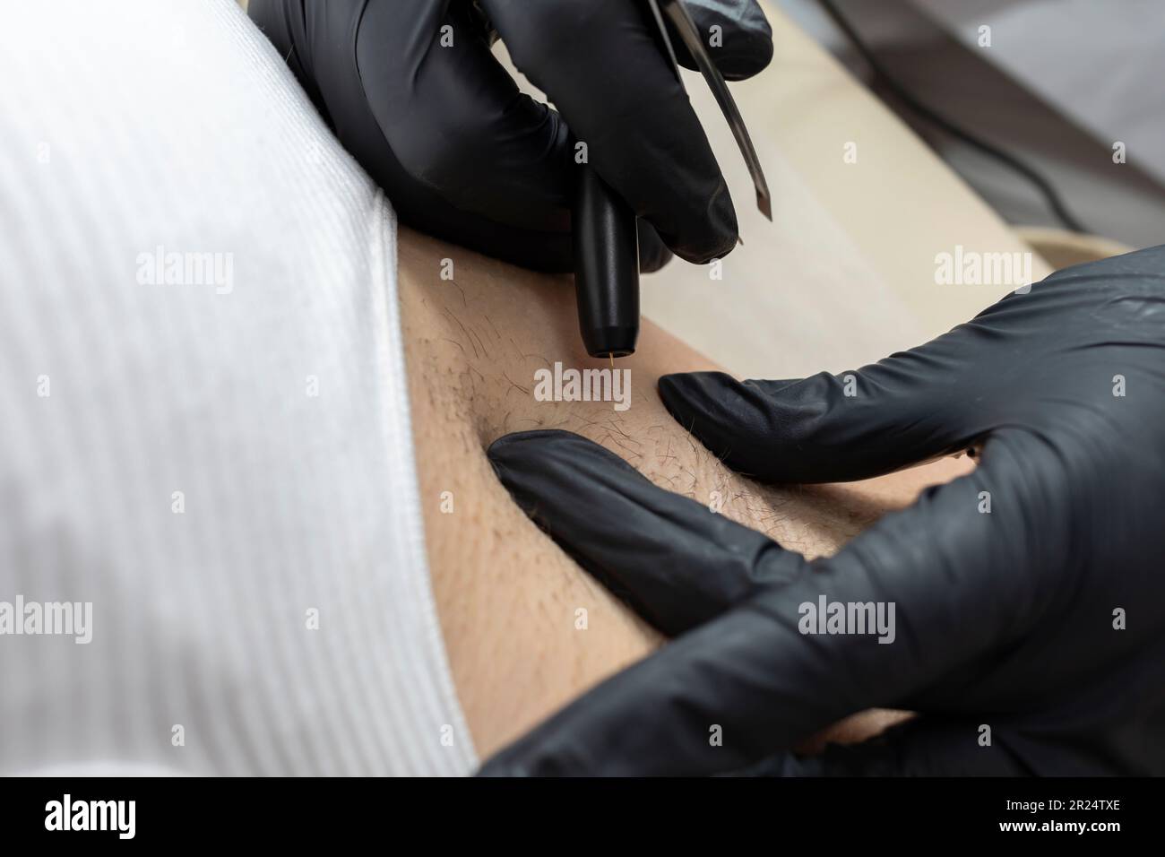 Closeup Dermatologist Removing Hair On Patient's Armpits With ...