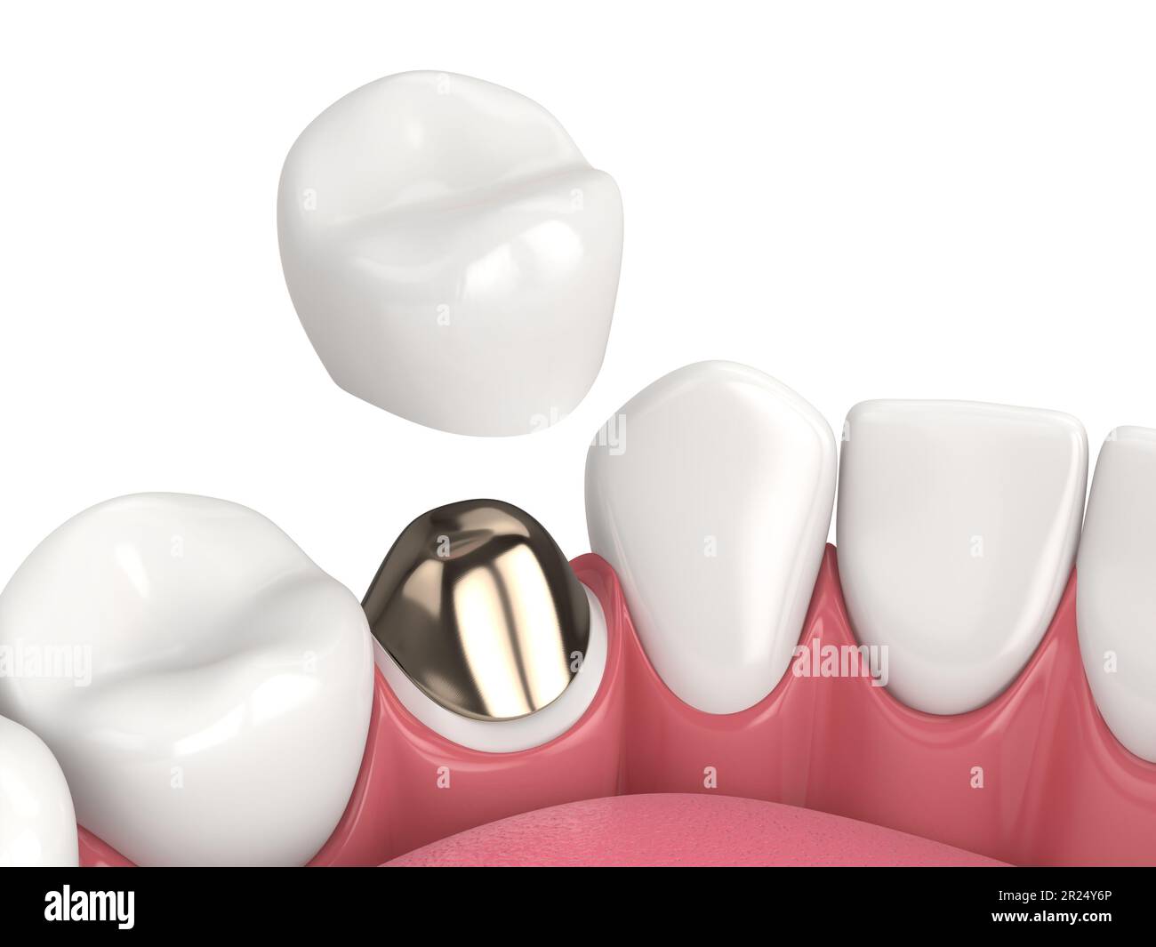 3d render of lower jaw with cast post and core tooth restoration over ...