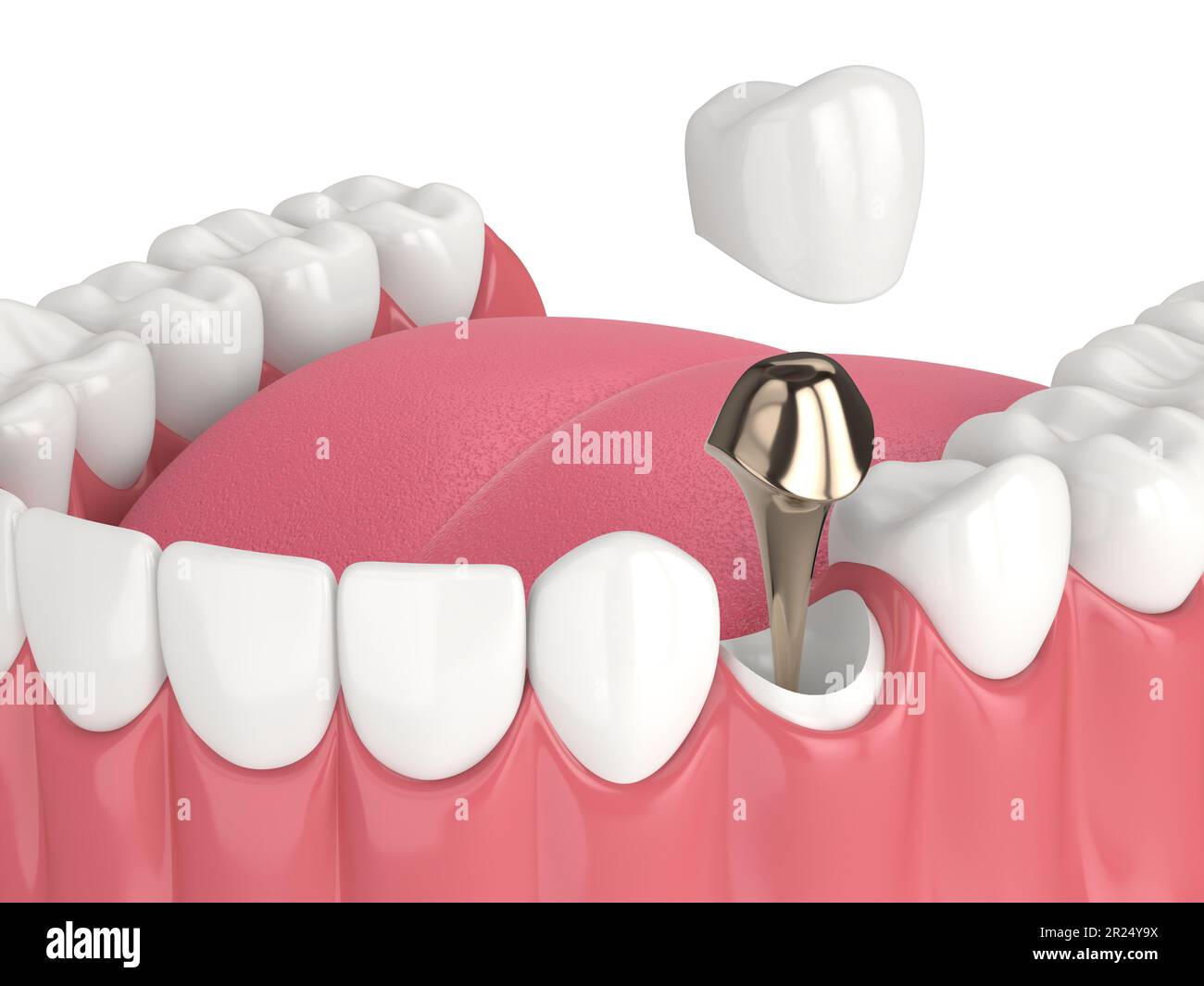3d render of lower jaw with cast post and core tooth restoration over ...