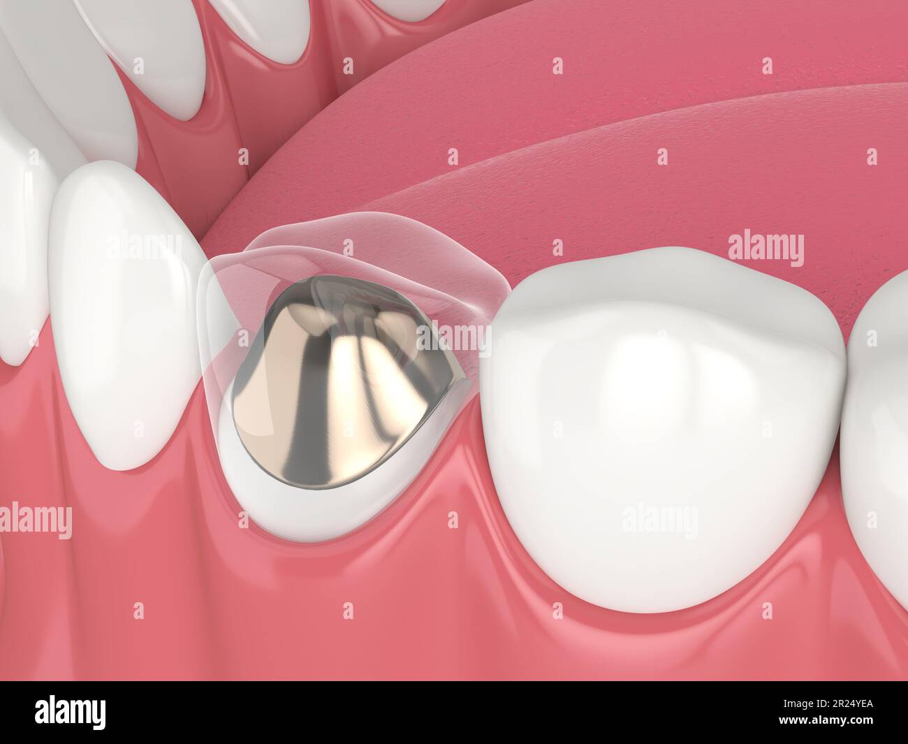 3d render of lower jaw with cast post and core tooth restoration over ...