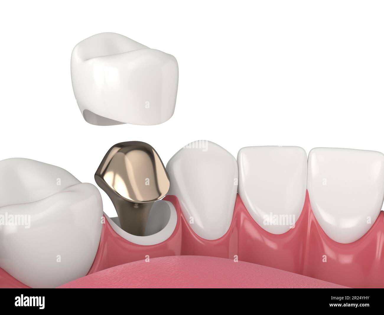 3d render of lower jaw with cast post and core tooth restoration over ...