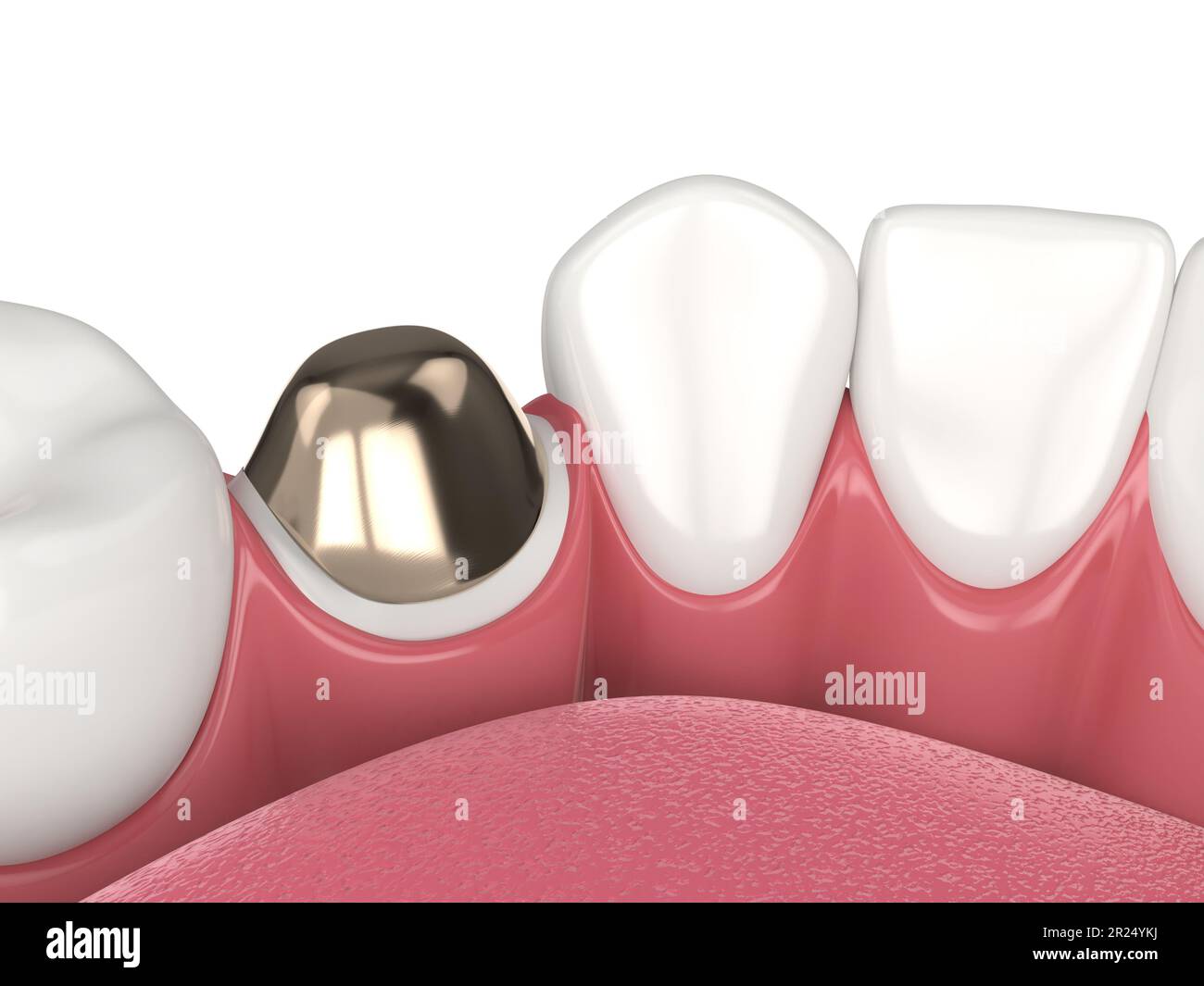 3d render of lower jaw with cast post and core tooth restoration over ...