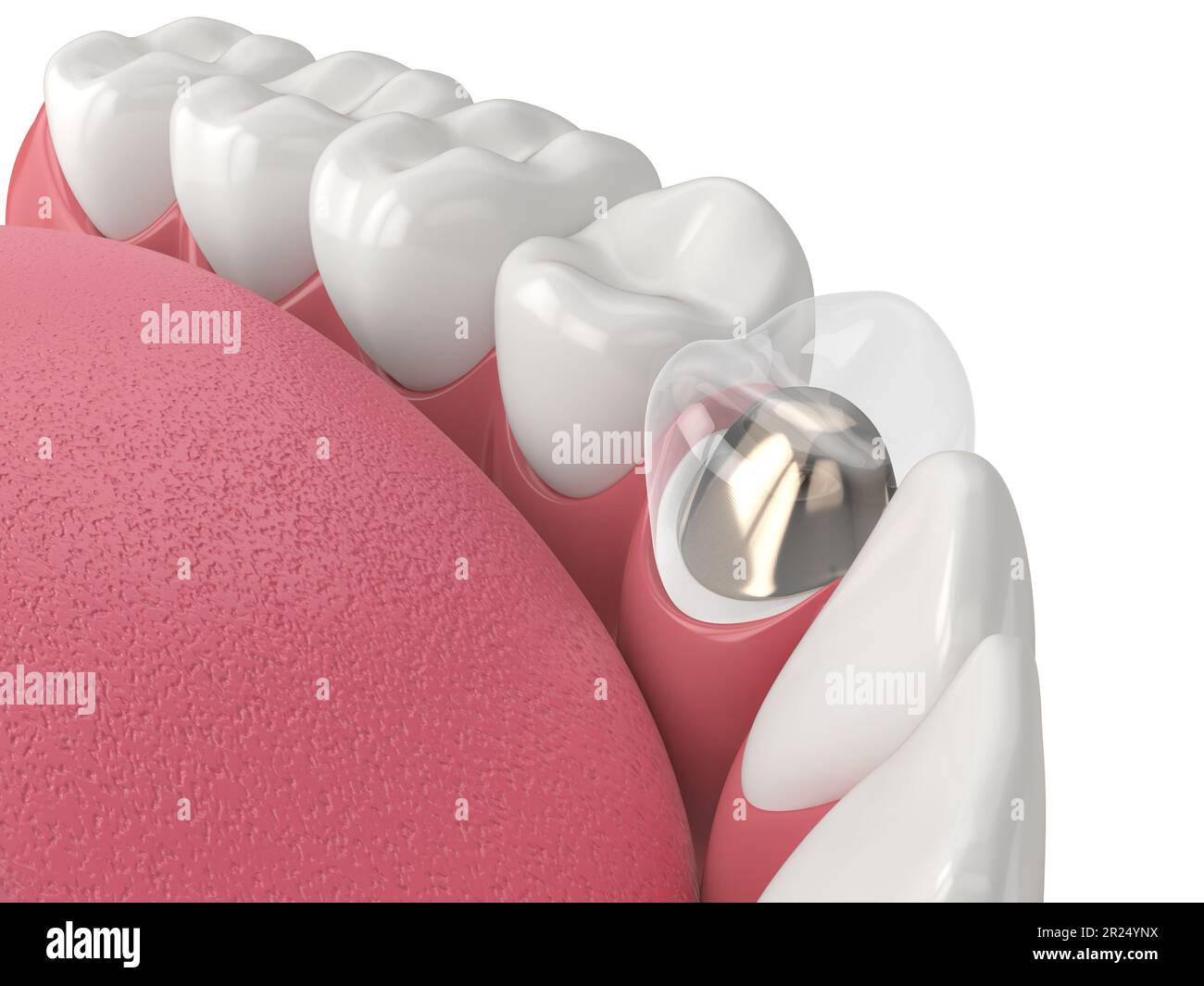 3d render of lower jaw with cast post and core tooth restoration over ...