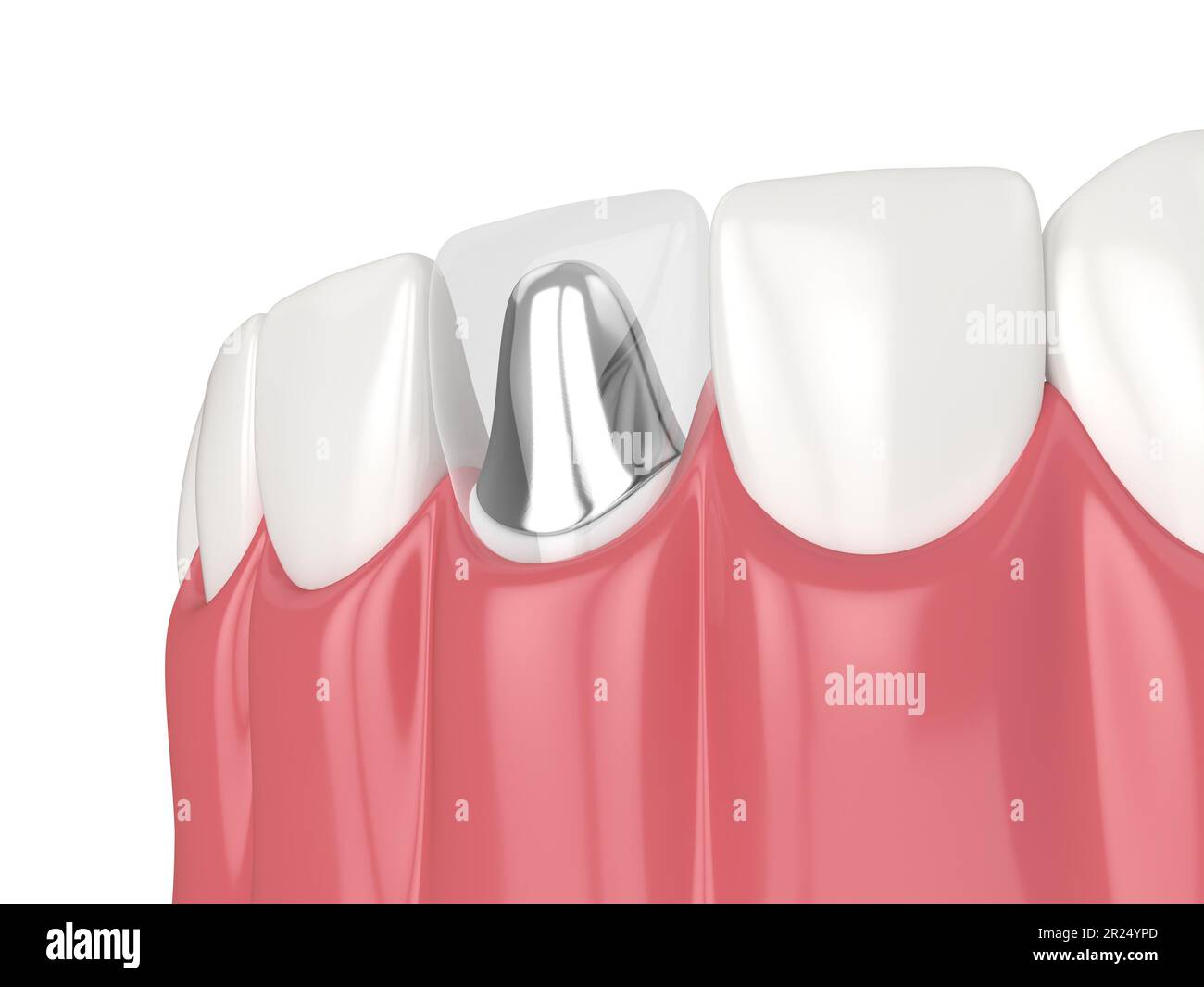 3d render of lower jaw with cast post and core tooth restoration over ...