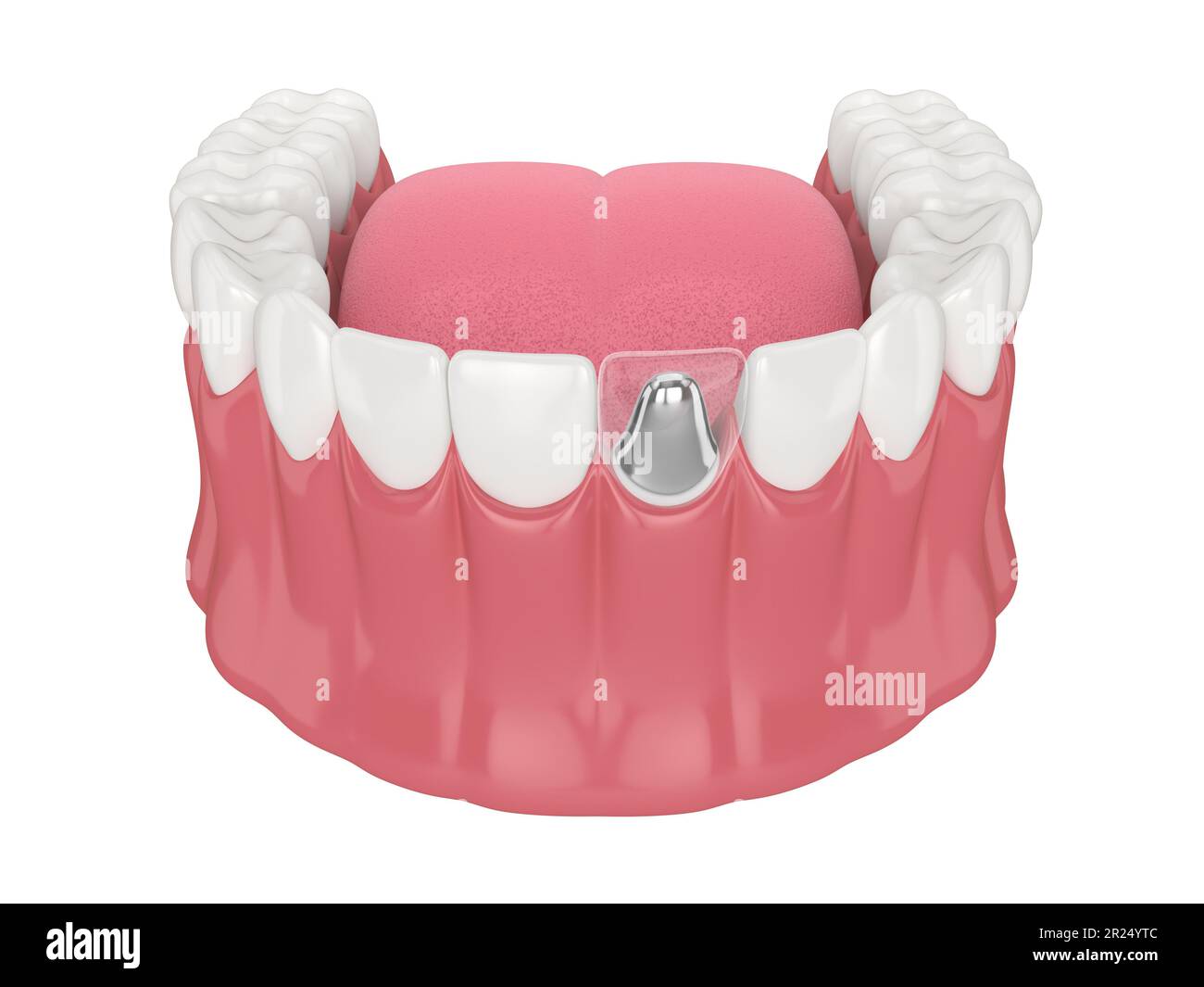 3d render of lower jaw with cast post and core tooth restoration over ...