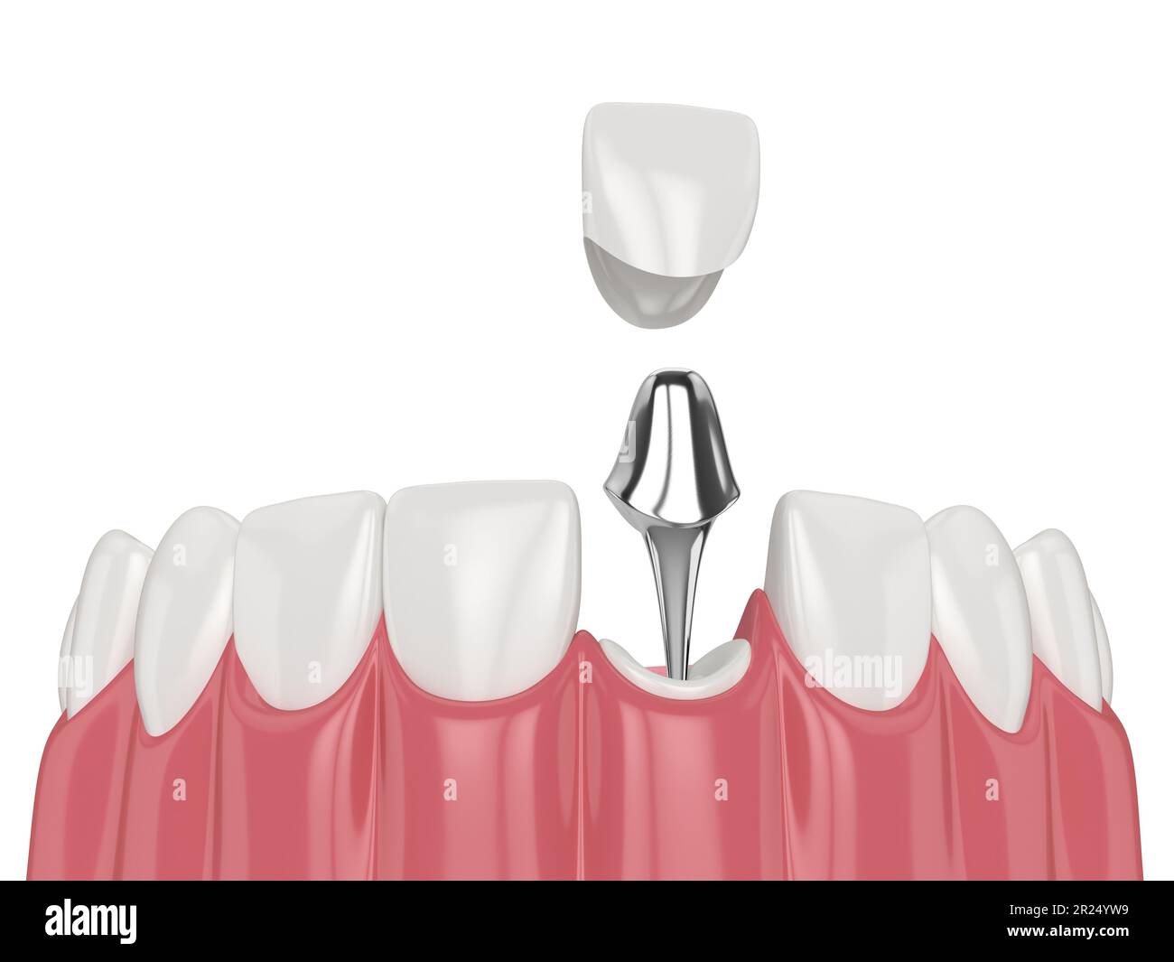 3d render of lower jaw with cast post and core tooth restoration over ...