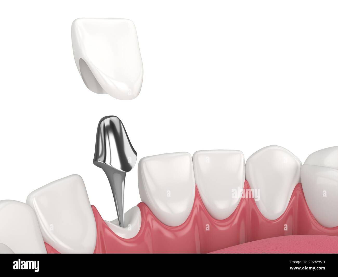 3d render of lower jaw with cast post and core tooth restoration over ...