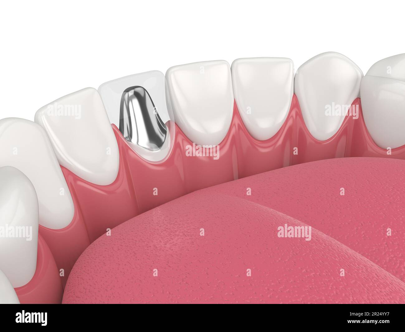 3d render of lower jaw with cast post and core tooth restoration over ...