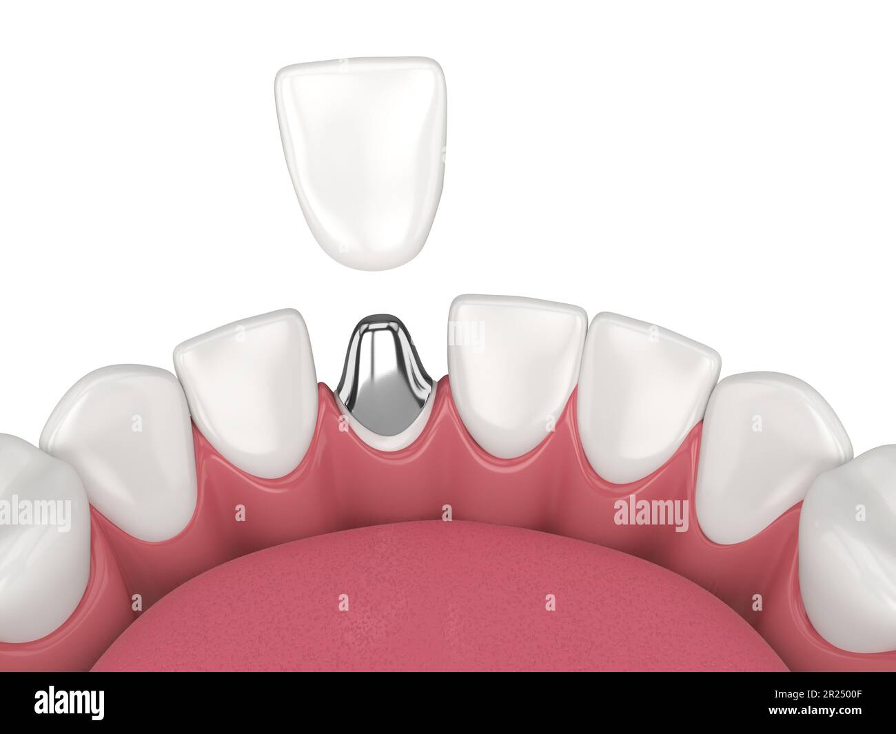 3d render of lower jaw with cast post and core tooth restoration over ...