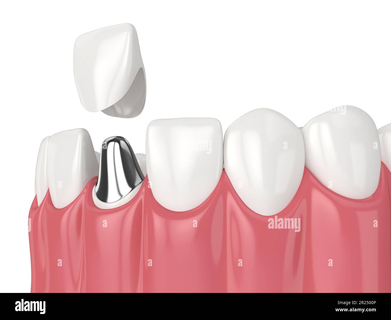 3d render of lower jaw with cast post and core tooth restoration over ...