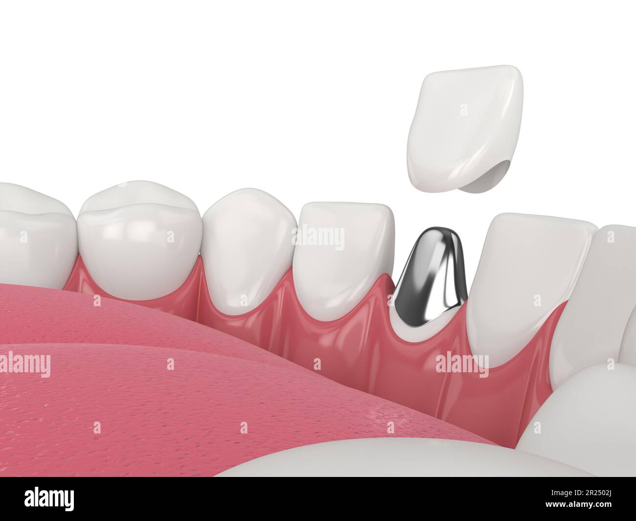 3d render of lower jaw with cast post and core tooth restoration over ...