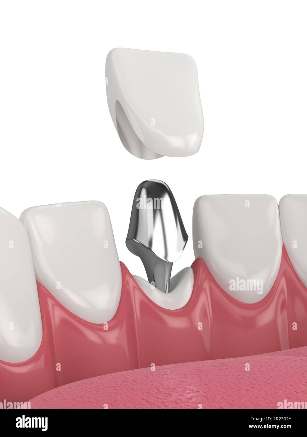 3d render of lower jaw with cast post and core tooth restoration over ...