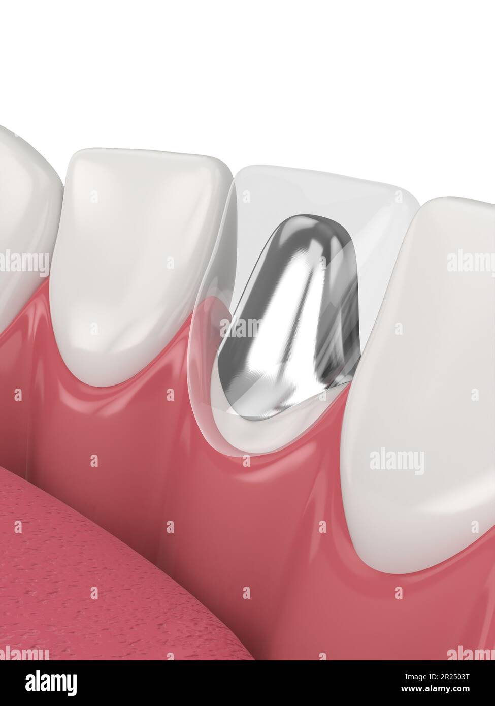 3d render of lower jaw with cast post and core tooth restoration over ...