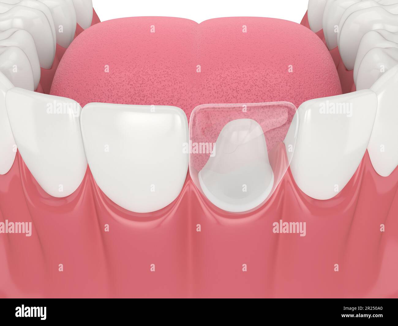 3d render of lower jaw with post and core tooth restoration over white ...