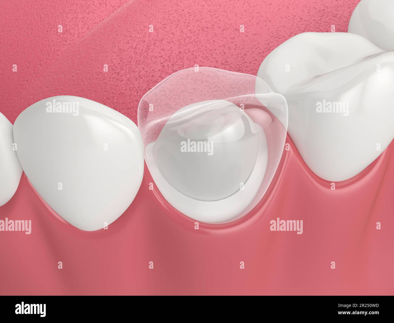 3d render of lower jaw with dental post and core tooth restoration over ...