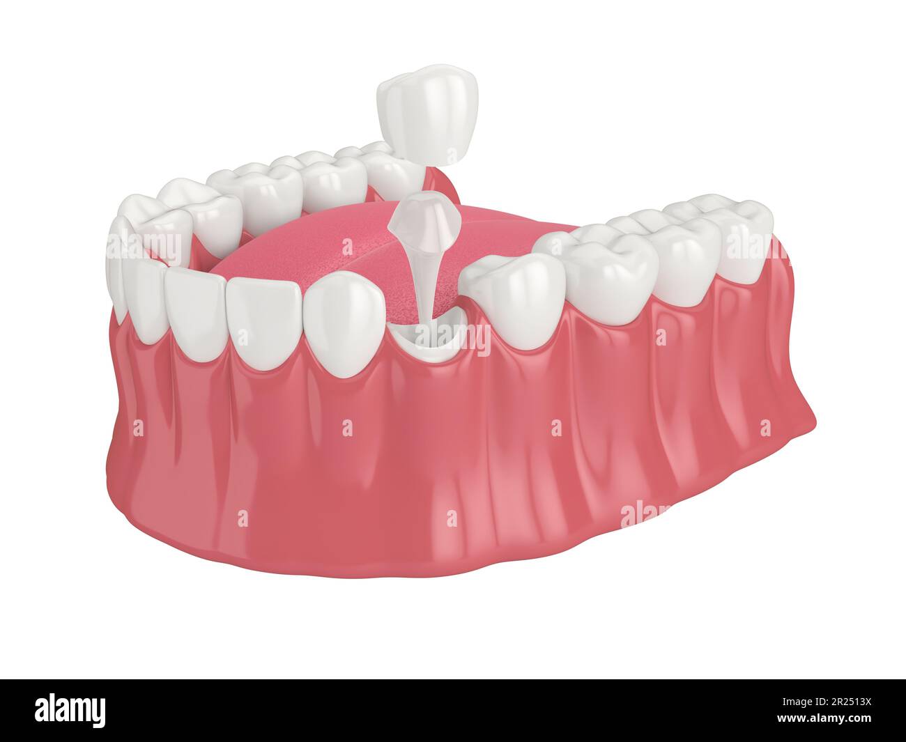 3d render of lower jaw with post and core tooth restoration over white ...