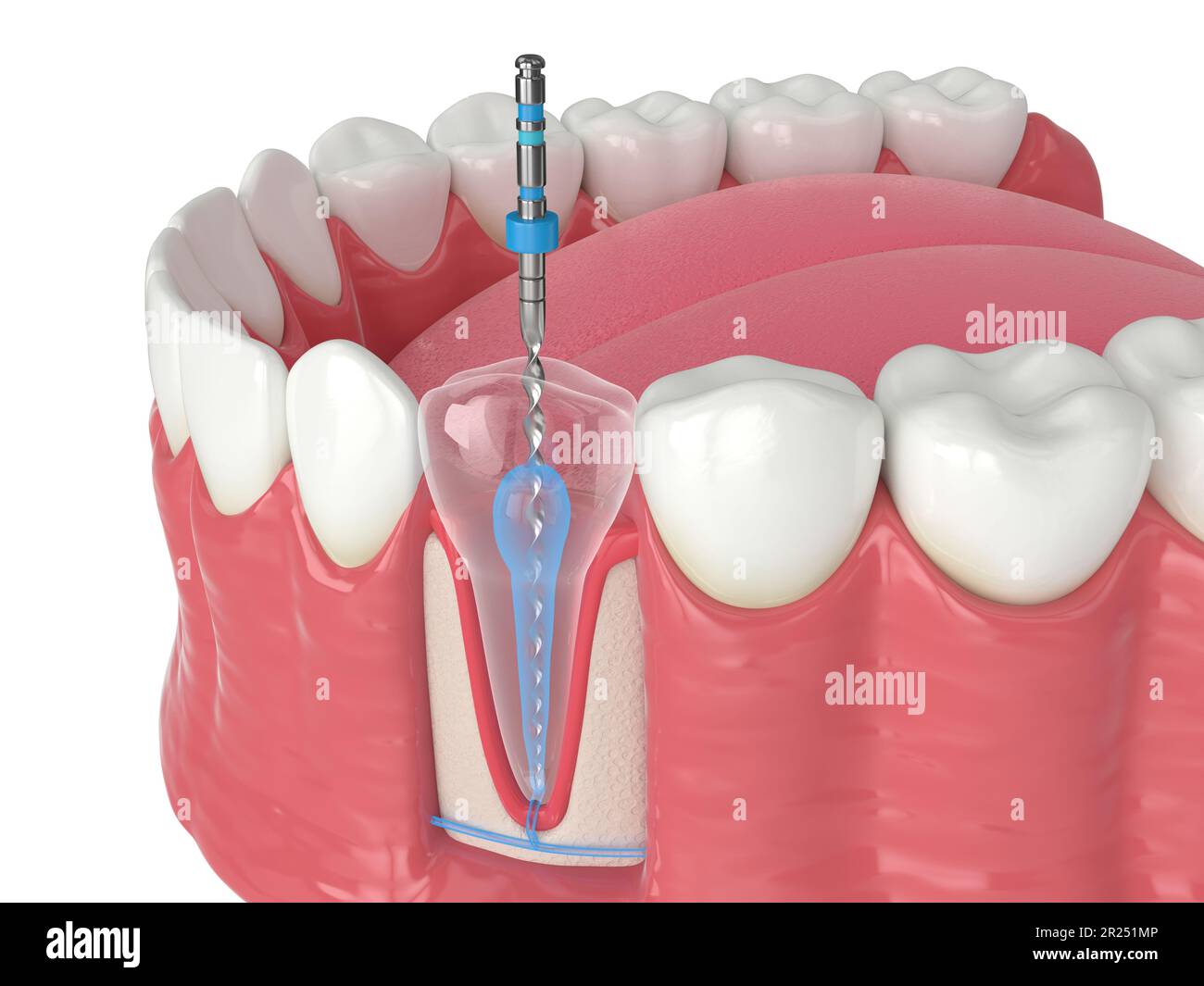 3d render of lower jaw with endodontic rotary file over white ...