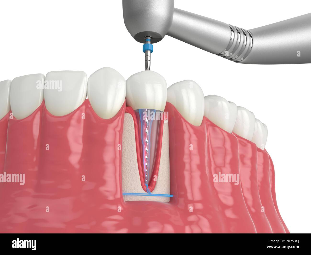3d render of lower jaw with handpiece and endodontic rotary file over ...