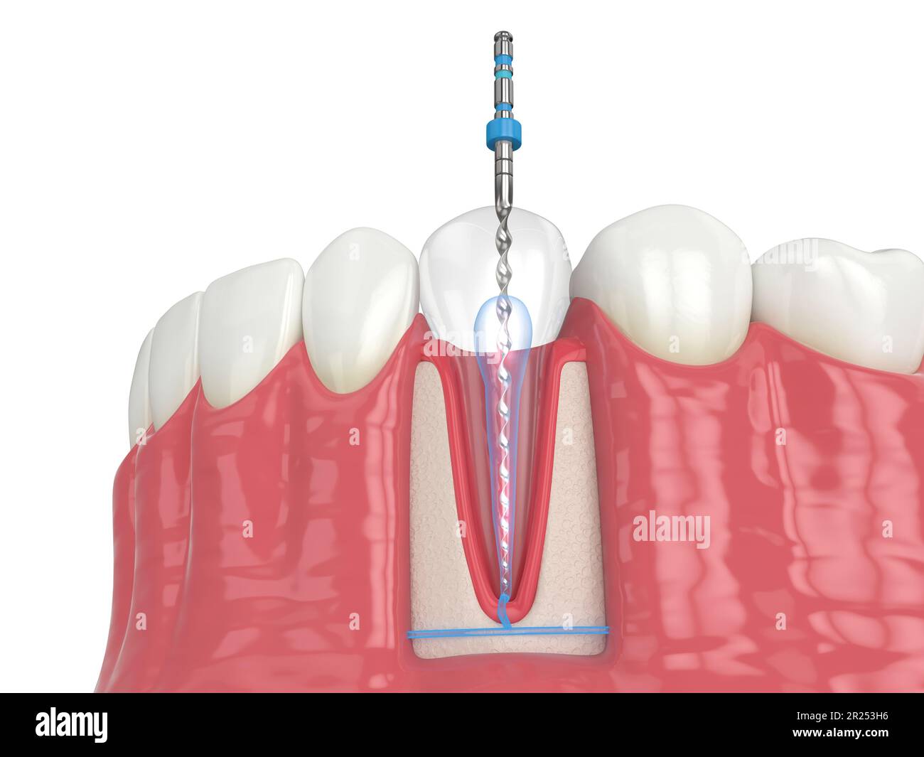 3d render of lower jaw with endodontic rotary file over white ...