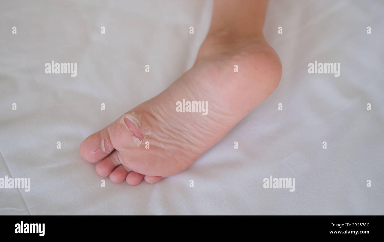 Heel of child with flaky skin after burn or injury closeup Stock Photo ...