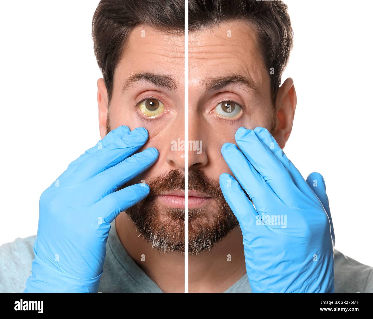 Collage with photos of man before and after hepatitis treatment. Doctor ...