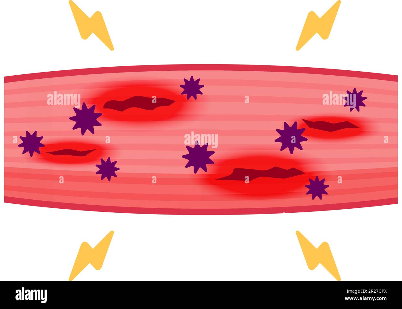 Mechanism of muscle soreness vector illustration Stock Vector Image ...