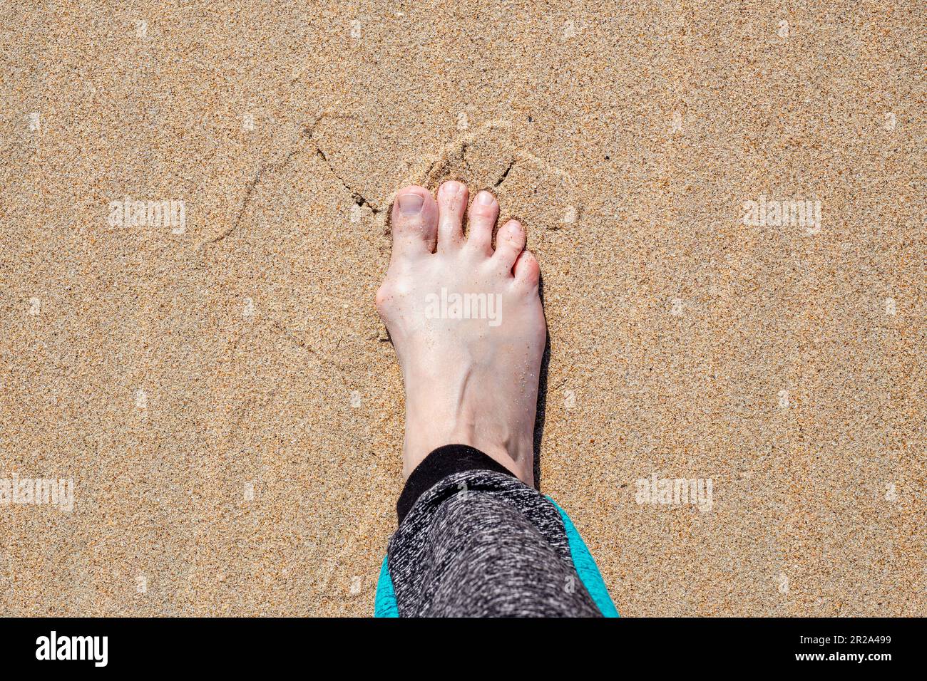 Female leg with an enlarged painful joint on the big toe on yellow sand ...