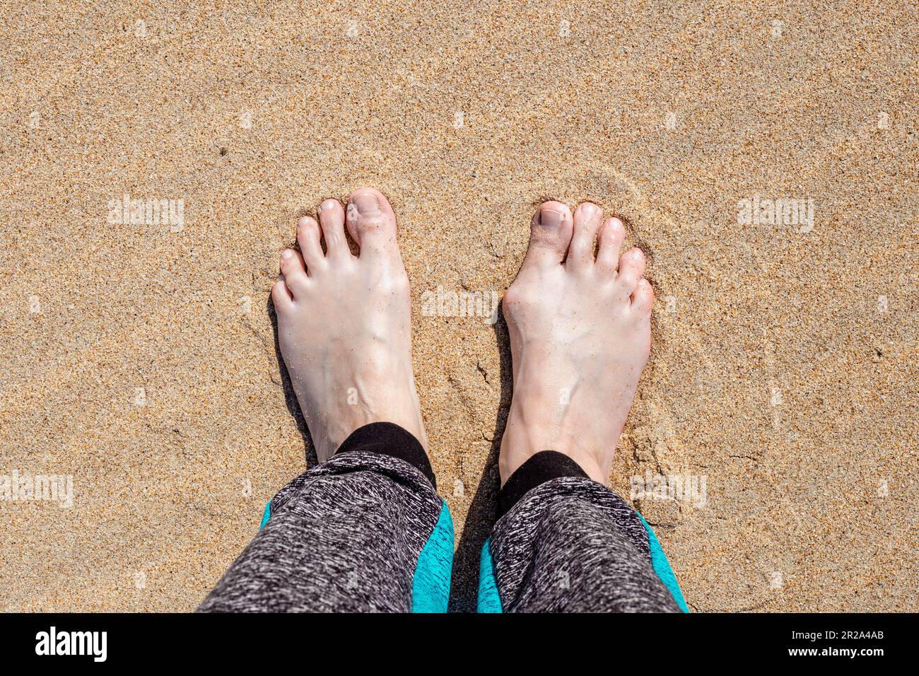 female feet with an increase in the joint of the big toe on the right ...