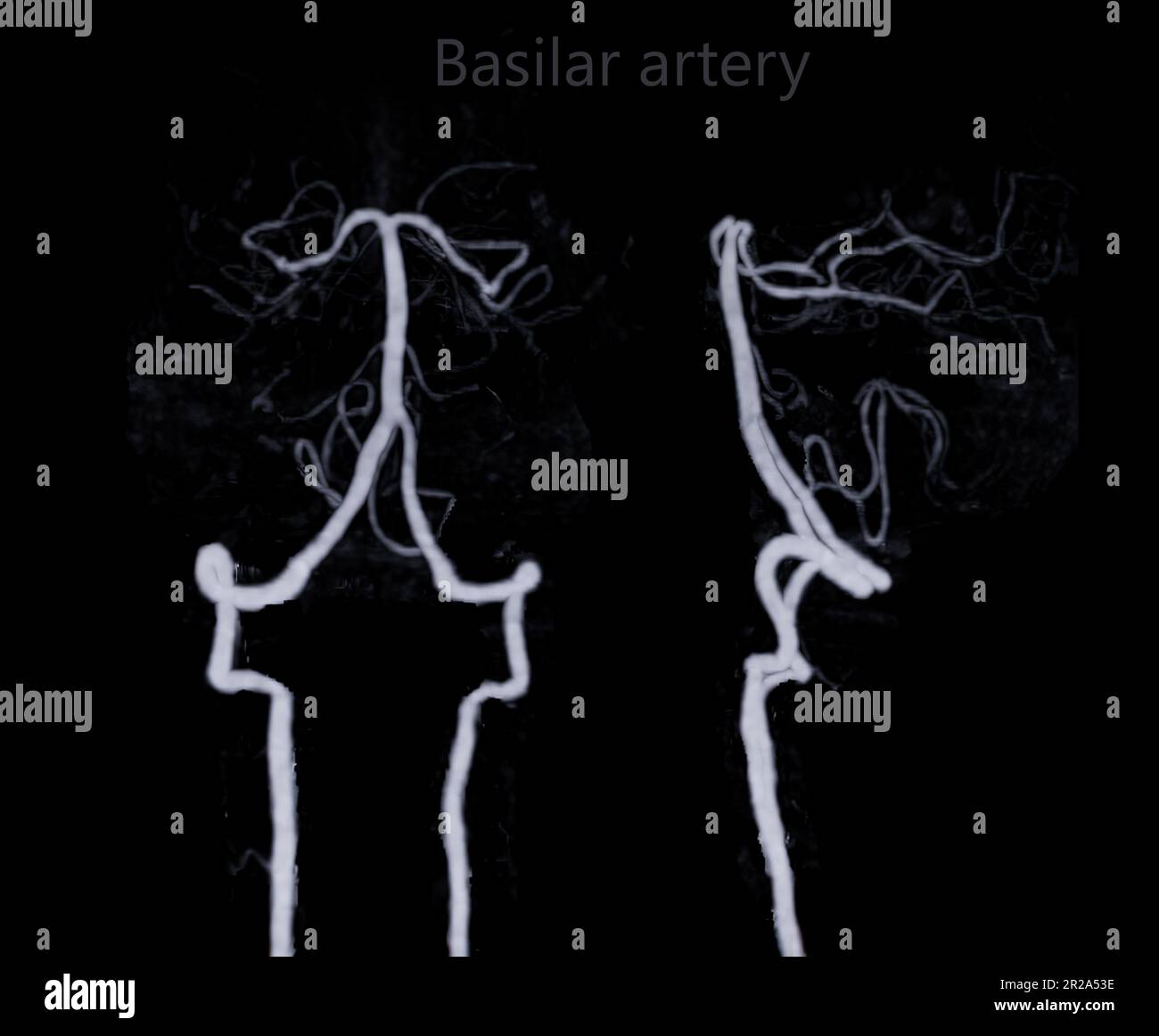 Ct Angiography Of The Brain Or Cta Brain Showing Basilar Artery Stock