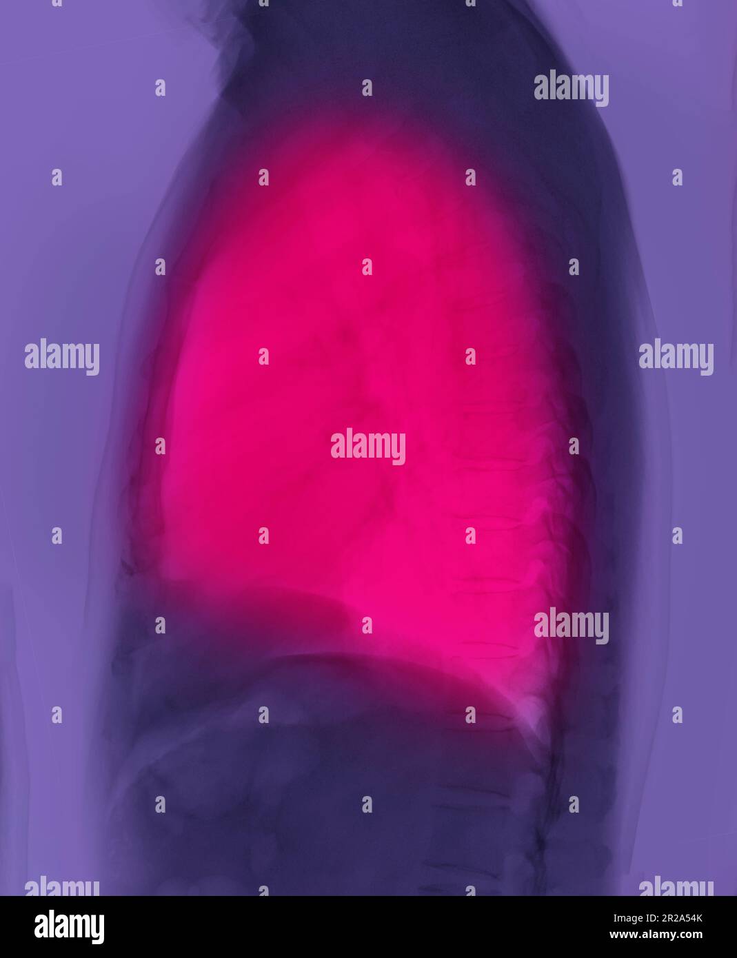 Chest X-ray or X-Ray Image of Human Lung Lateral View with full ...