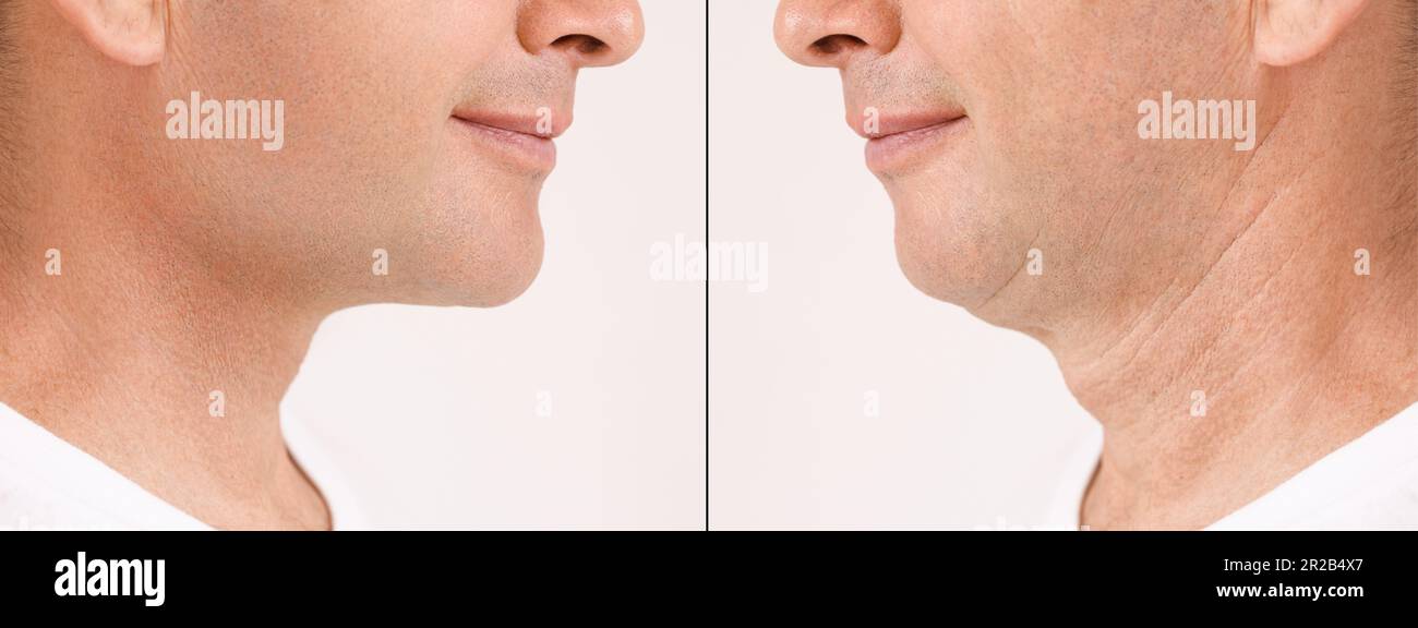 A close portrait of an aged man before and after the facial ...