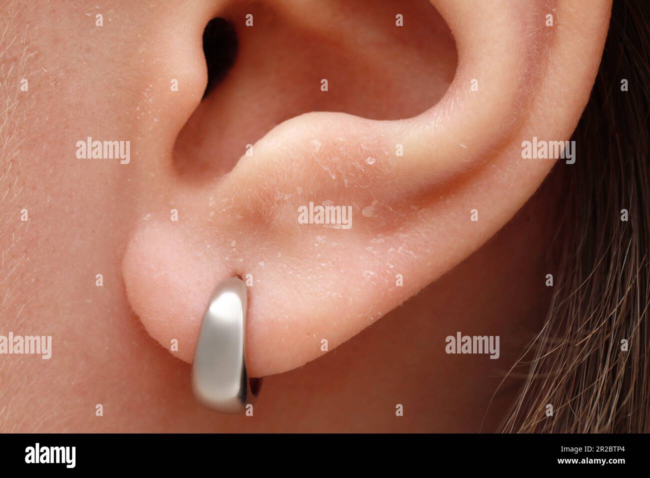 Red rash ear hi-res stock photography and images - Alamy