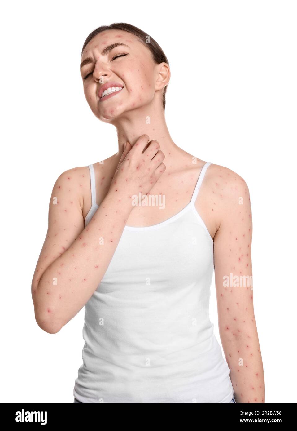 Woman with rash suffering from monkeypox virus on white background ...