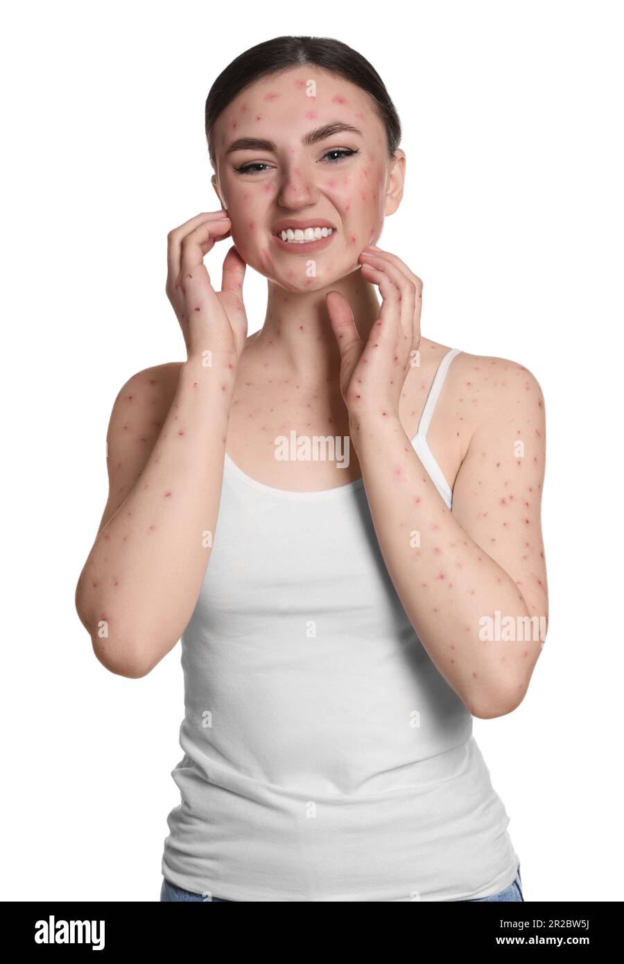 Woman with rash suffering from monkeypox virus on white background ...