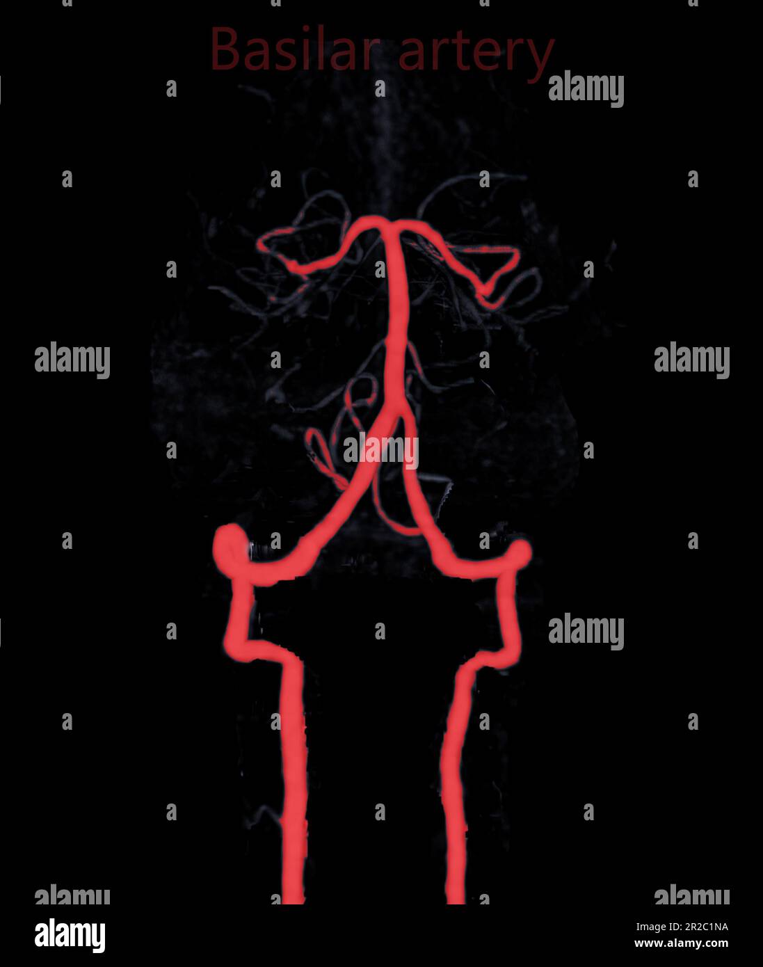 Ct Angiography Of The Brain Or Cta Brain Showing Basilar Artery Stock