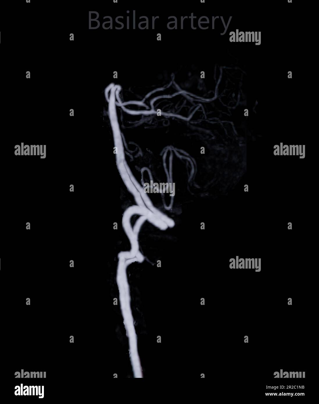 Ct Angiography Of The Brain Or Cta Brain Showing Basilar Artery Stock