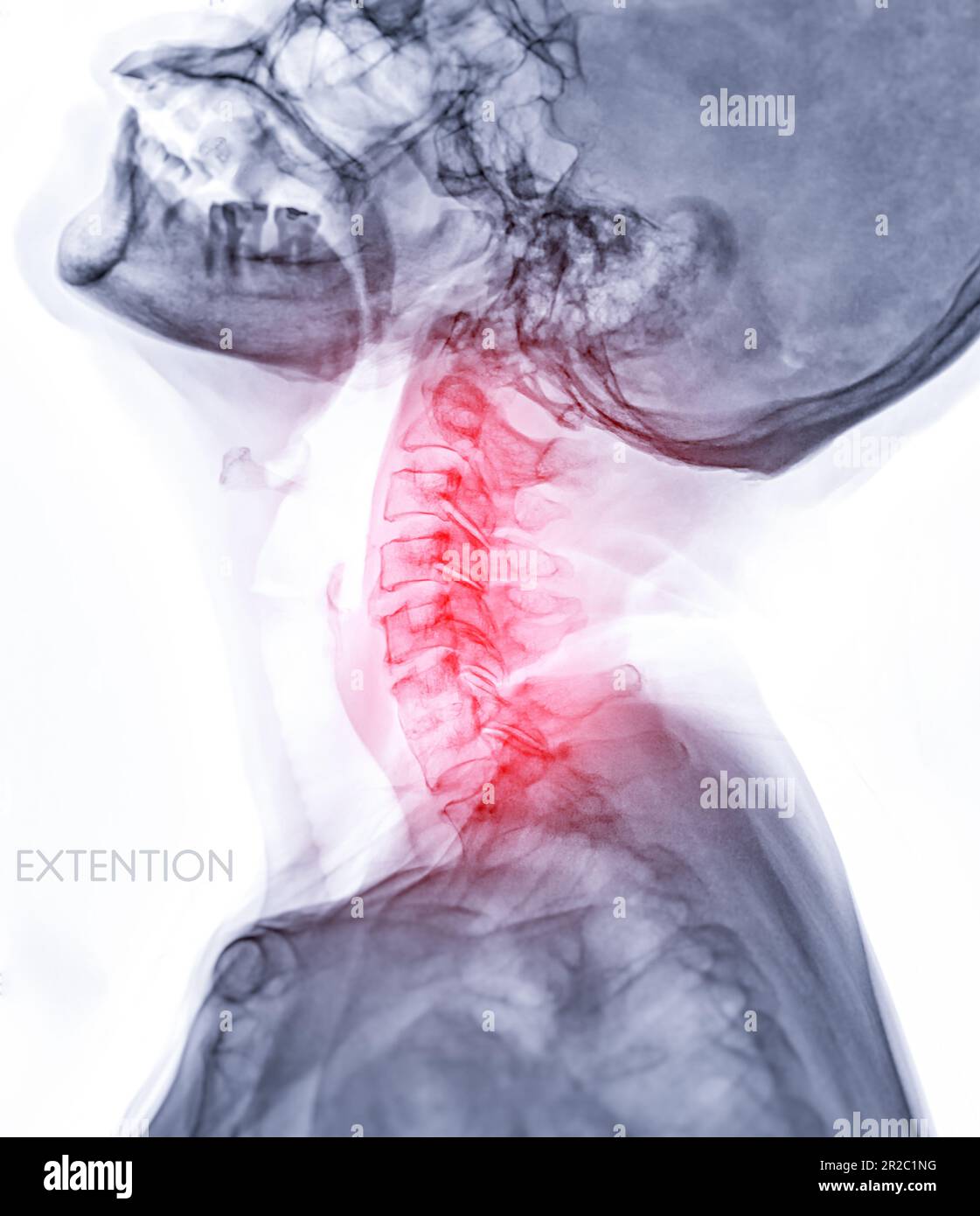Extension X Ray Cervical Spine Cosmokoti