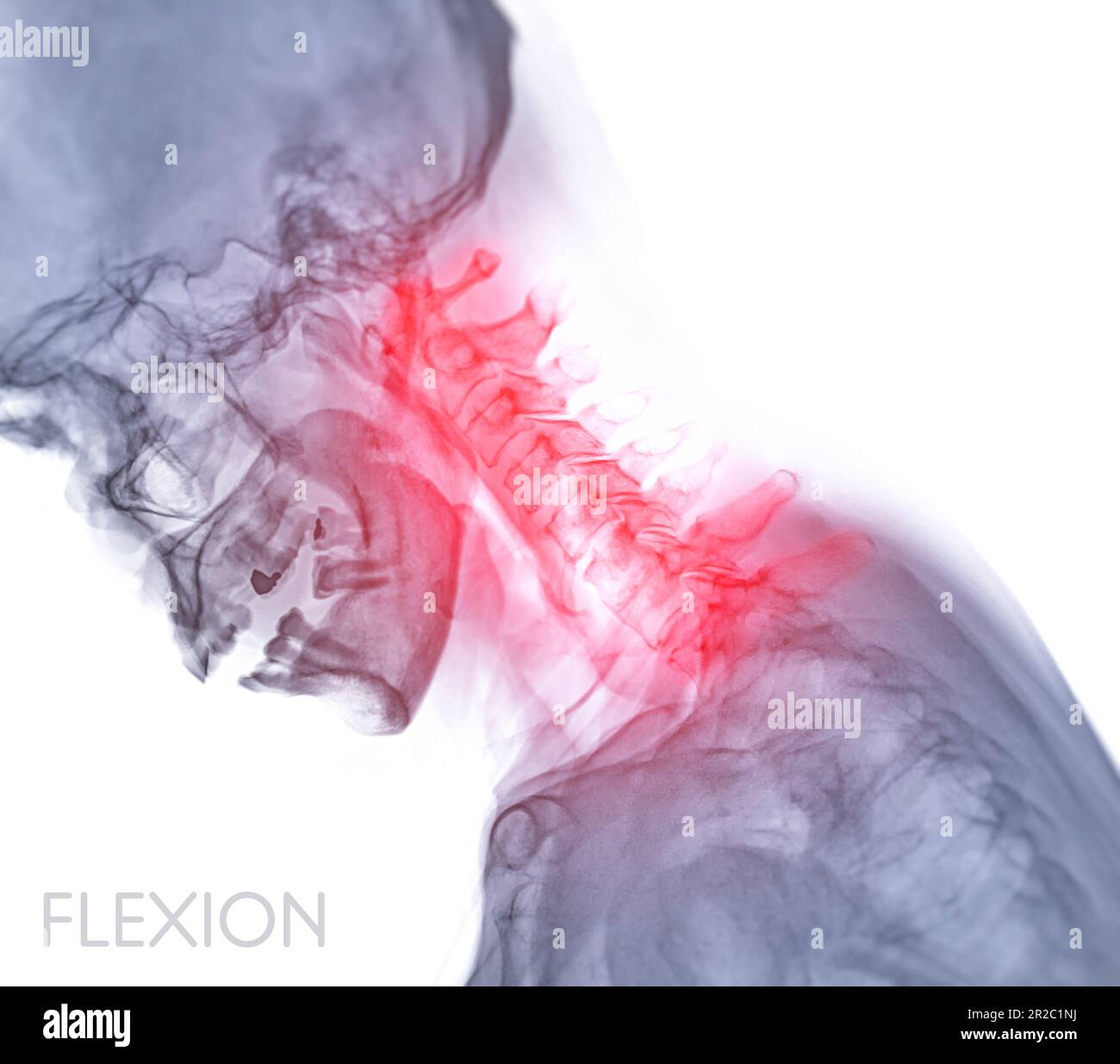 Flexion X Ray Cervical Spine Issejunkie
