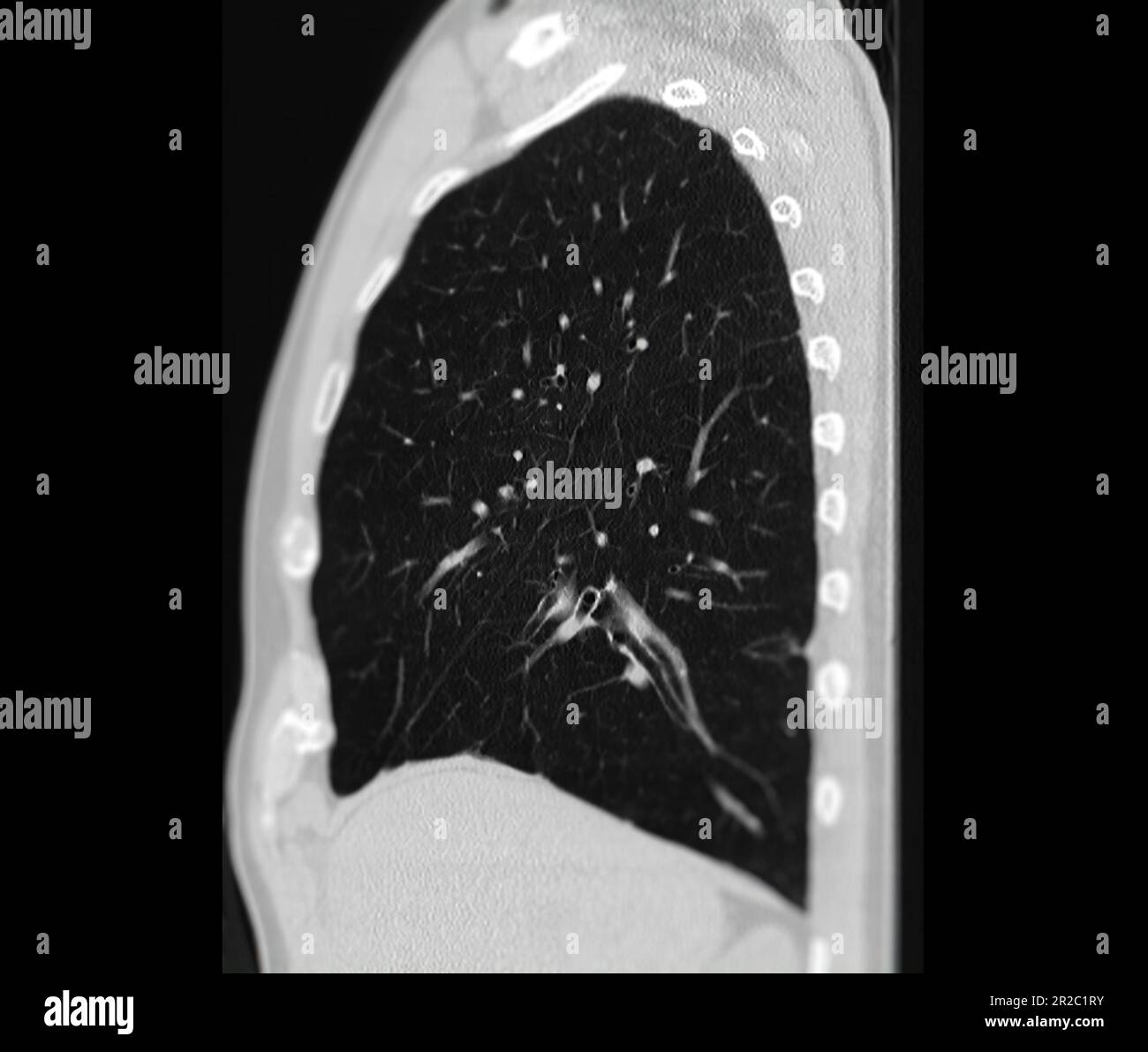 Ct Scan Of Chest Or Lung For Screening Lung Nodules And Lung Cancer