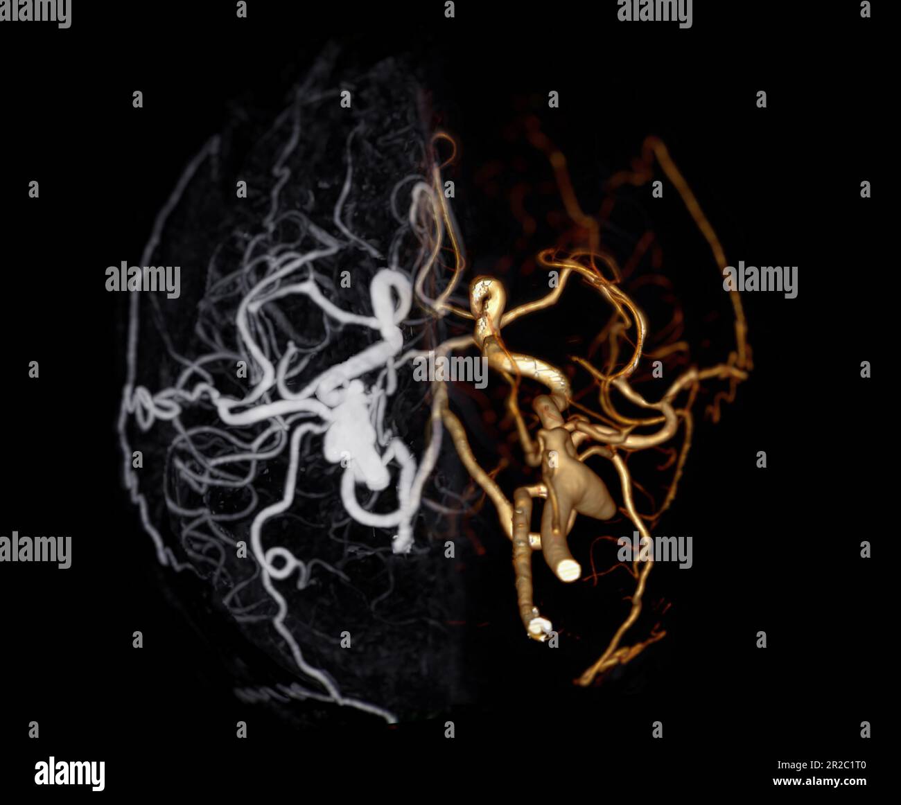 Ct Angiography Of The Brain Or Cta Brain Showing Cerebral Artery Stock