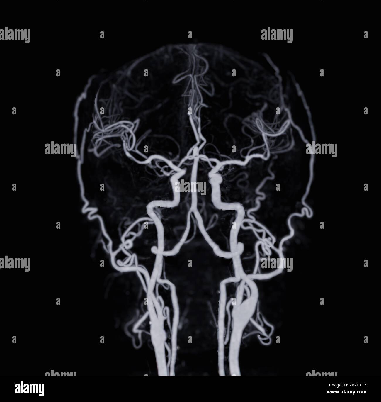 Ct Angiography Of The Brain Or Cta Brain Showing Cerebral Artery Stock