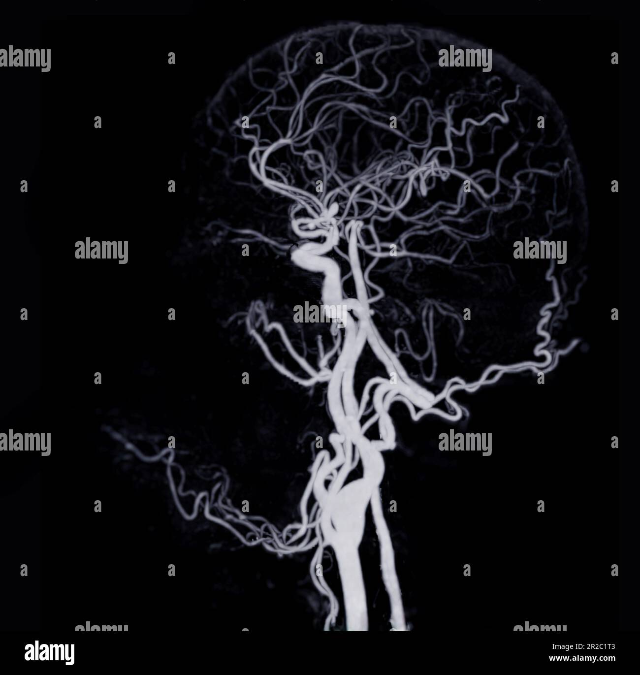 Ct Angiography Of The Brain Or Cta Brain Showing Cerebral Artery Stock