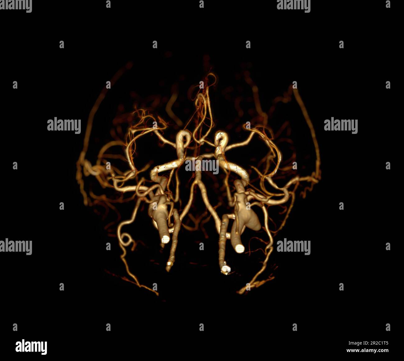 Ct Angiography Of The Brain Or Cta Brain Showing Cerebral Artery Stock