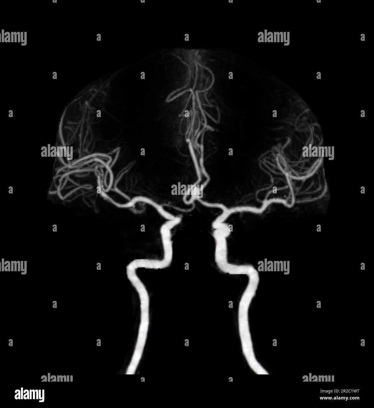CT angiography of the brain or CTA brain showing Cerebral artery Stock ...
