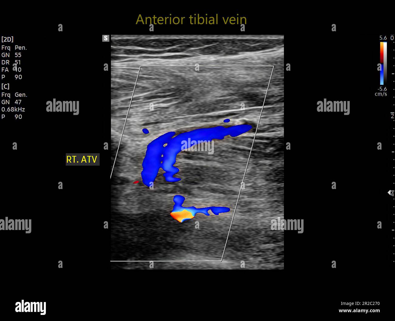 Color Doppler ultrasound determination in deep vein thrombosis patients ...
