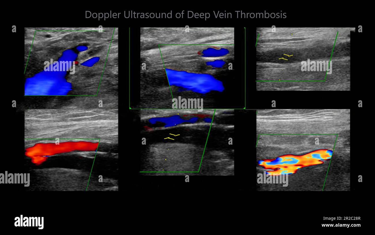 Color Doppler ultrasound determination in deep vein thrombosis patients ...